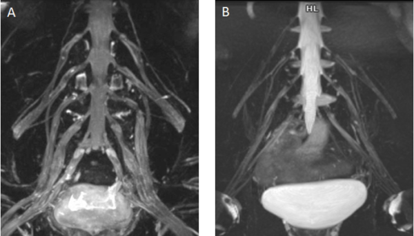 SFNP L’imagerie dans les neuropathies périphériques - SFNP